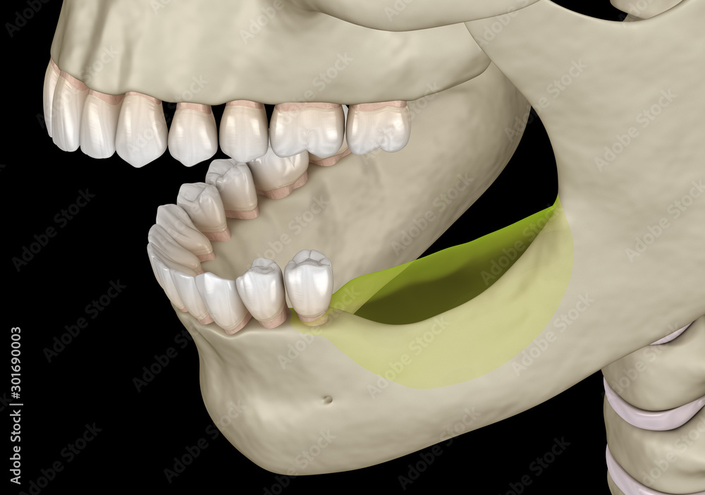 Mandibular Jaw, bone recession after losing molars teeth. Medically ...