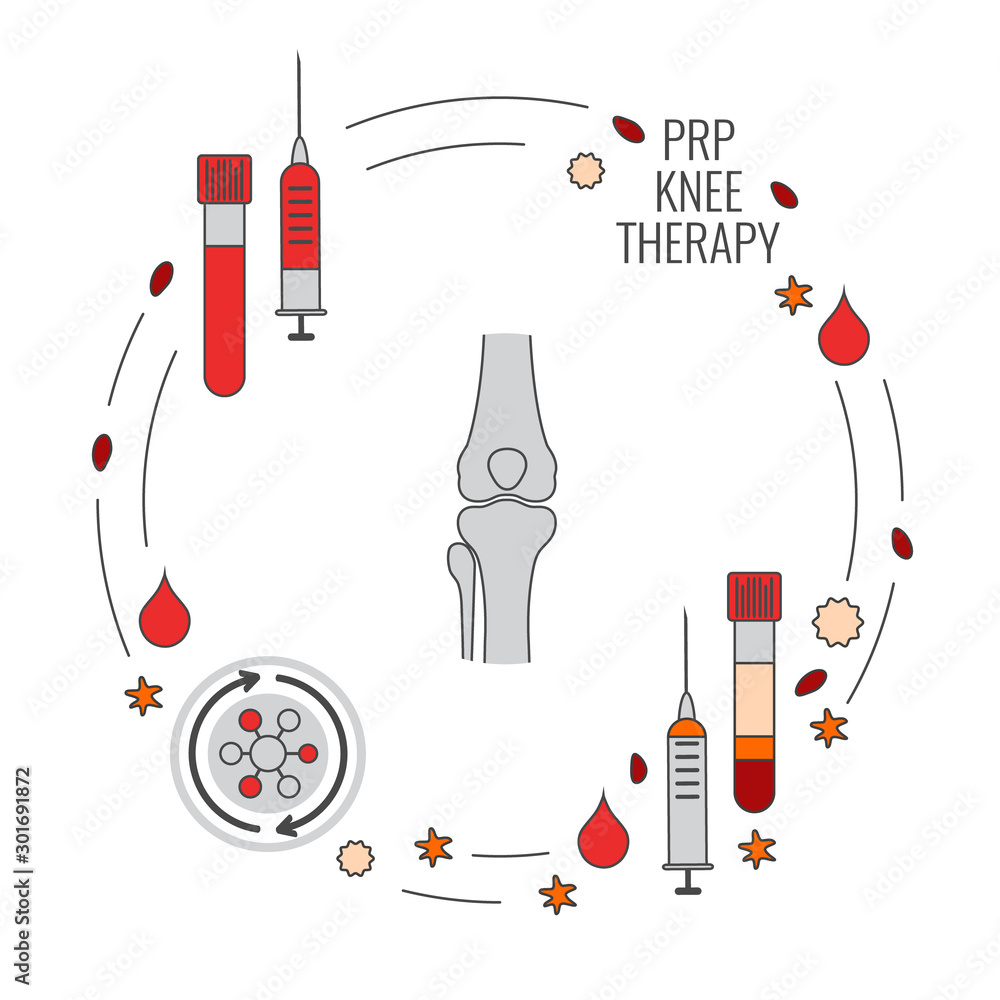 PRP injection for knee arthritis and osteoarthritis treatment. Separation of platelets in the ...