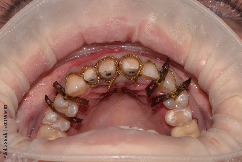 Turning and preparing teeth for ceramic veneers and crowns. Micro ...