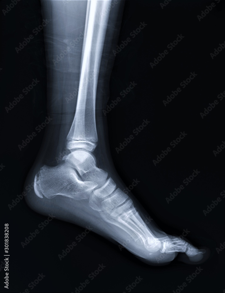 normal radiography of the ankle joint in lateral projection ...