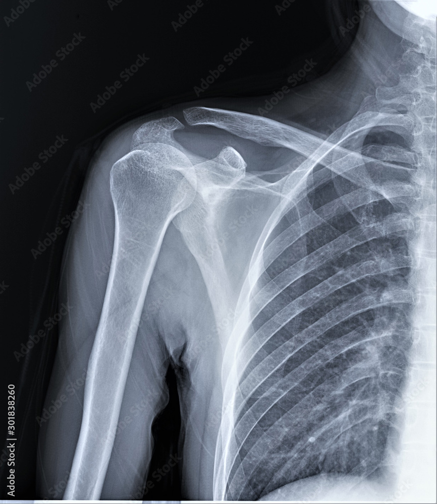 Foto de normal radiography of the shoulder joint in direct projection ...