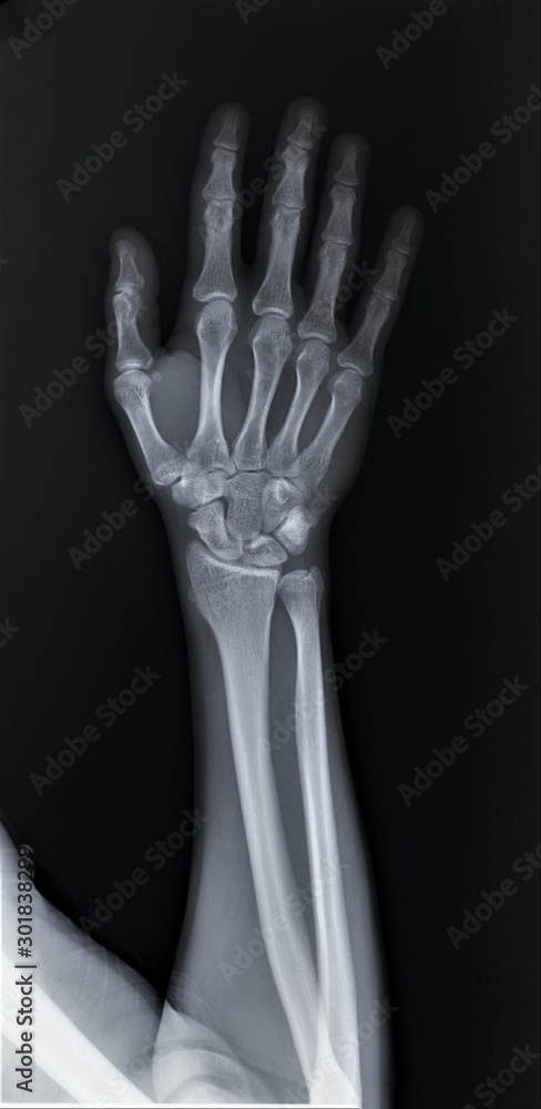 normal radiography of hand and wrist bones, traumatology and ...