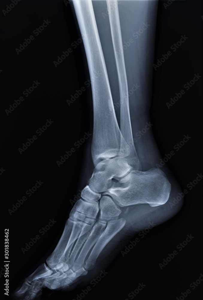 normal radiography of the ankle joint in lateral projection ...