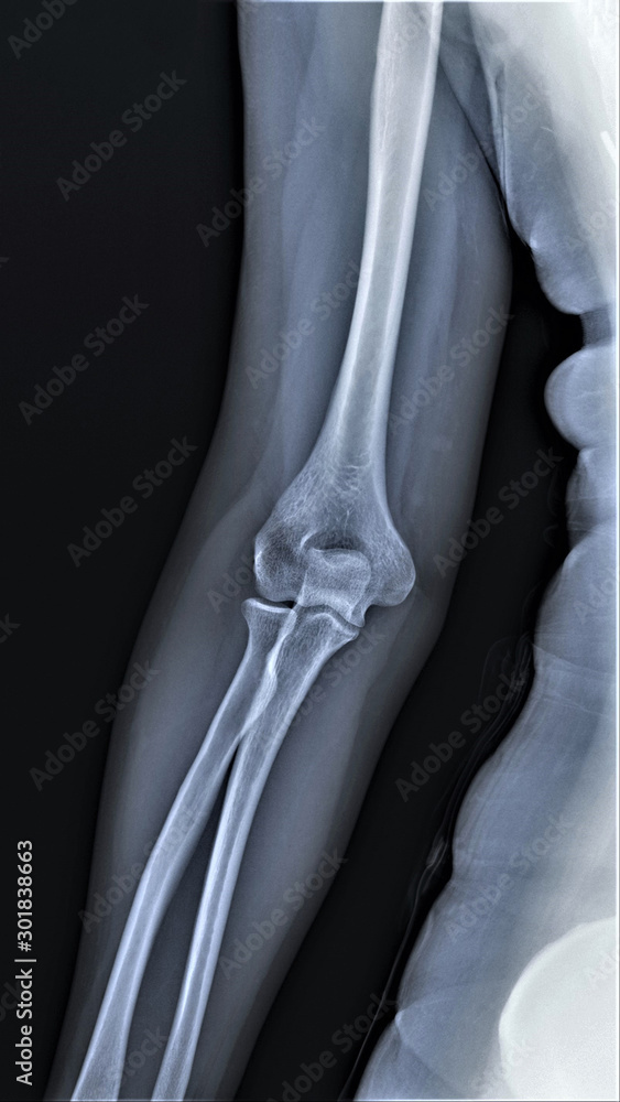 x-ray of the normal elbow joint. traumatology and orthopedics, medical ...