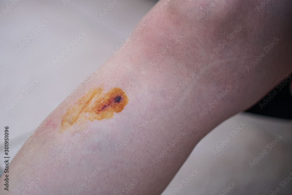 Injured scratch on her leg. Stock Photo | Adobe Stock