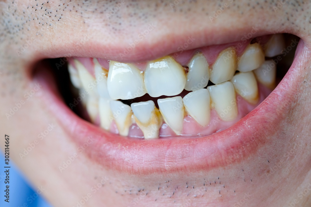 Tooth's a man smoking bad. Man smokes a cigarettes have tooth decay and ...