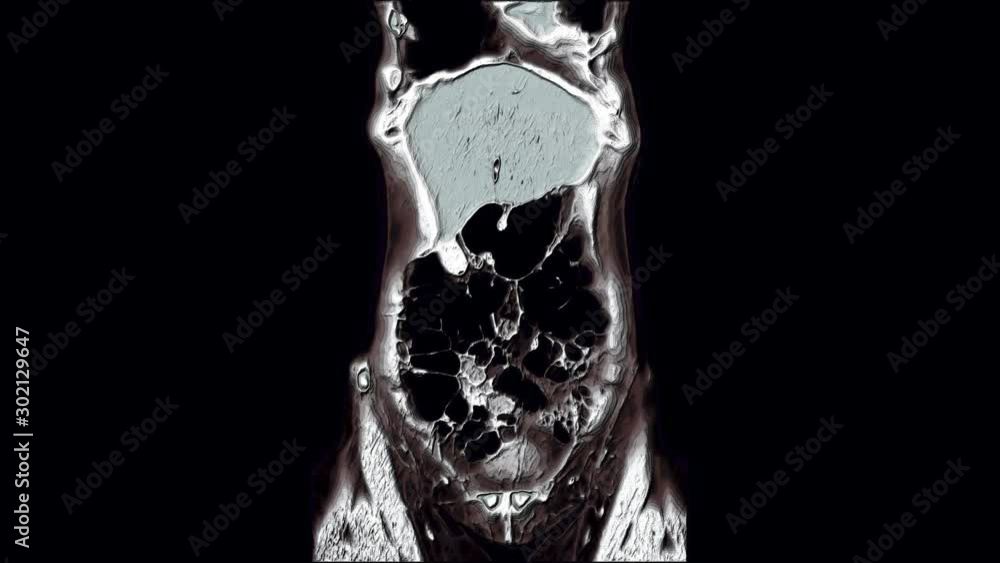 Contrast MRI of the abdominal cavity, gastrointestinal tract, bladder ...