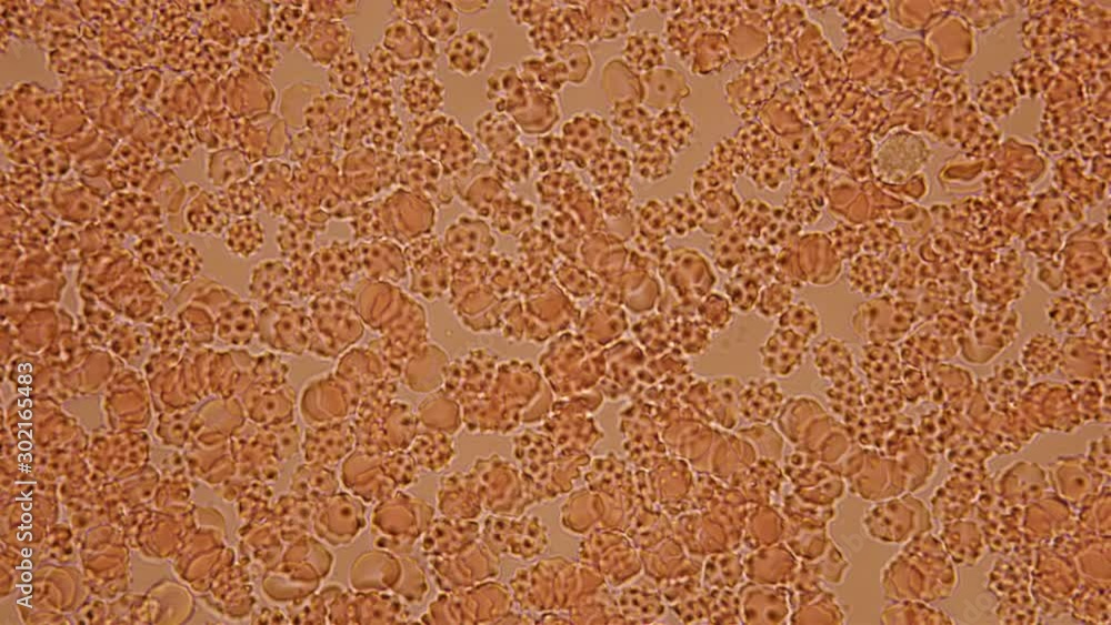 Blood under a microscope, the movement of spur-shaped red blood cells ...