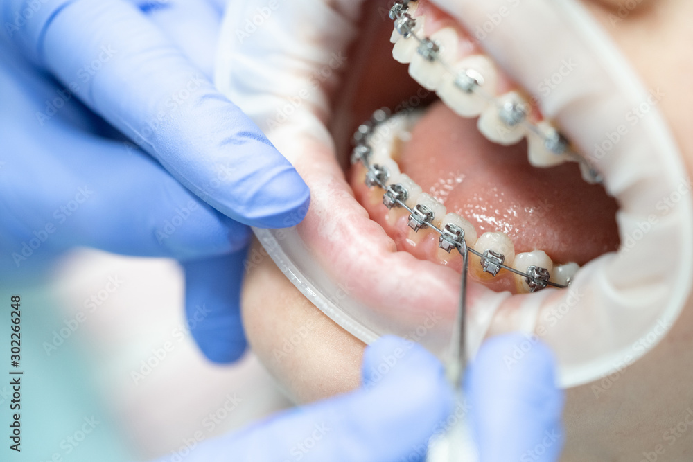 Close-up of teeth with braces. Dentistry and the procedure for adjusting iron braces on the ...