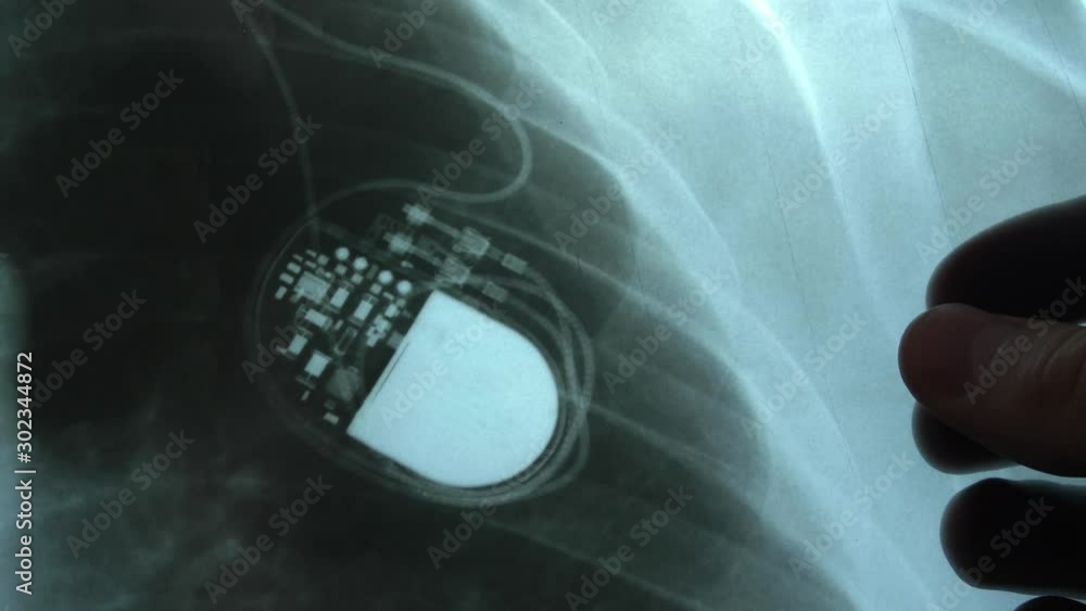 Doctor Examining X-Ray Image of Chest with Artificial Cardiac Pacemaker ...