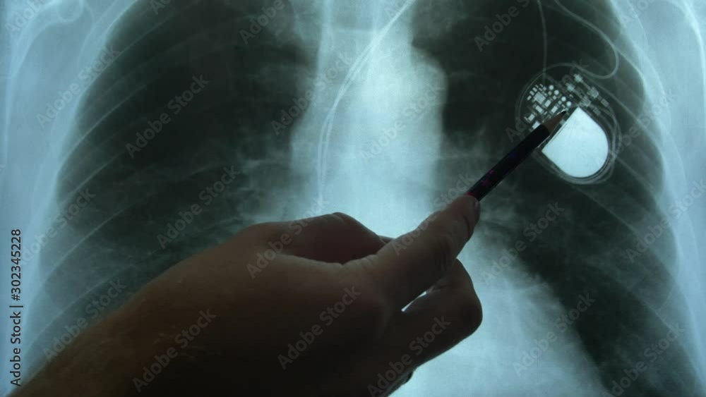 Doctor Examining X-Ray Image of Chest with Artificial Cardiac Pacemaker ...