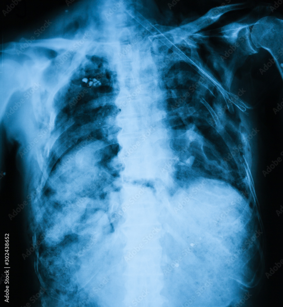 Chest x-ray image of a dead man, car accident Stock Photo | Adobe Stock