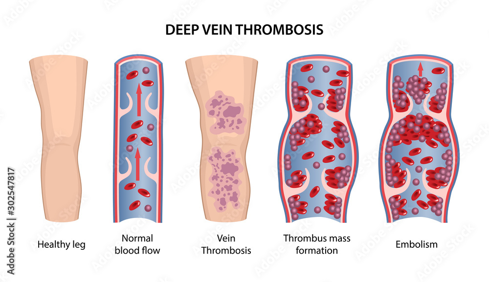 Deep vein thrombosis. Image of healthy and diseased legs. A ...