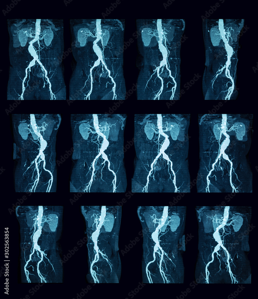 Computed Tomography Angiography Cta Of The Abdomen And Pelvis Stock