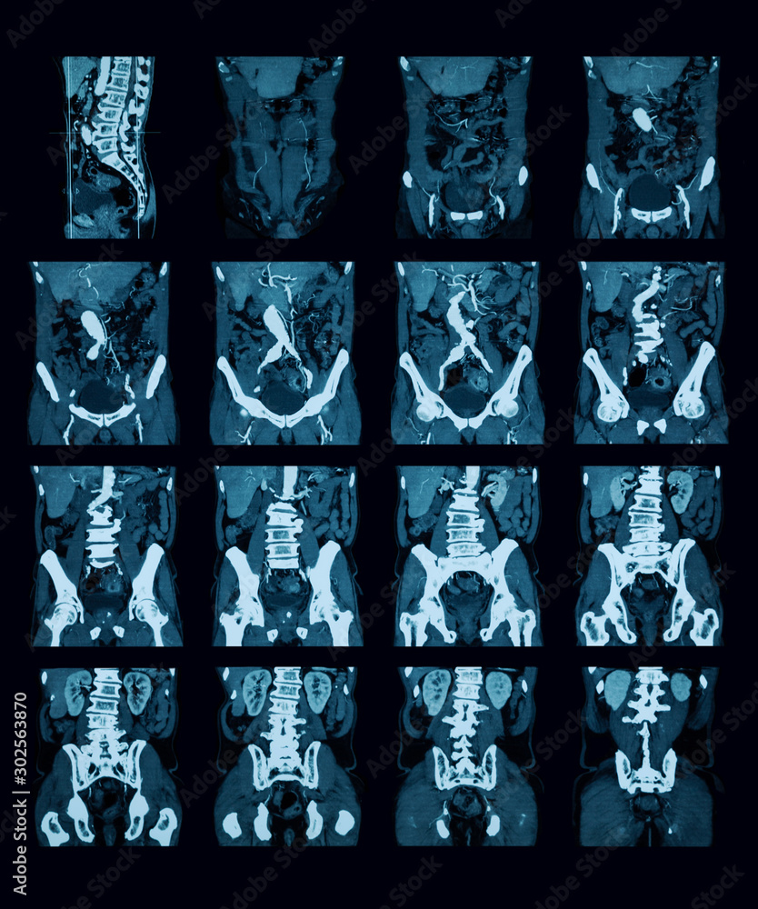 Computed tomography (CT) of the abdomen and pelvisComputed tomography ...