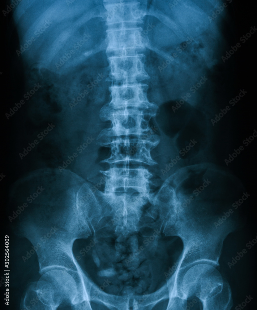 X-ray image of lumbosacral spine, anteroposterior (AP) view, show ...