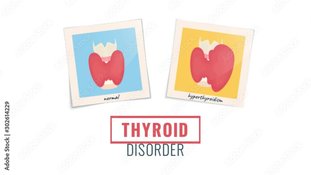 Cartoon animation of photo frames of hyperthyroid and healthy glands ...
