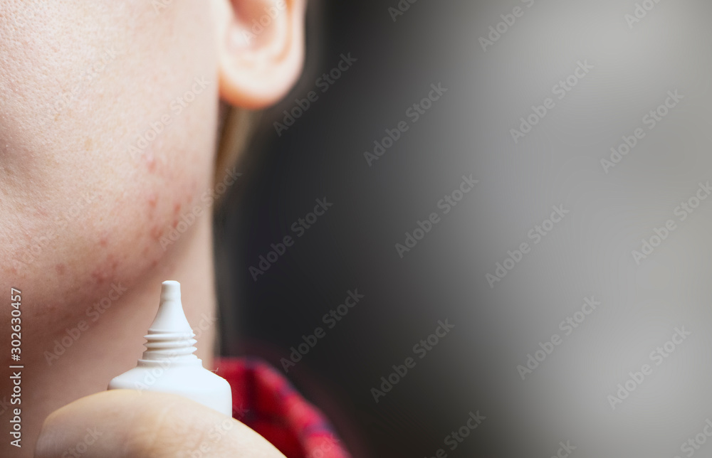 Acne on the chin: demodecosis tick on the skin of a girl's face ...