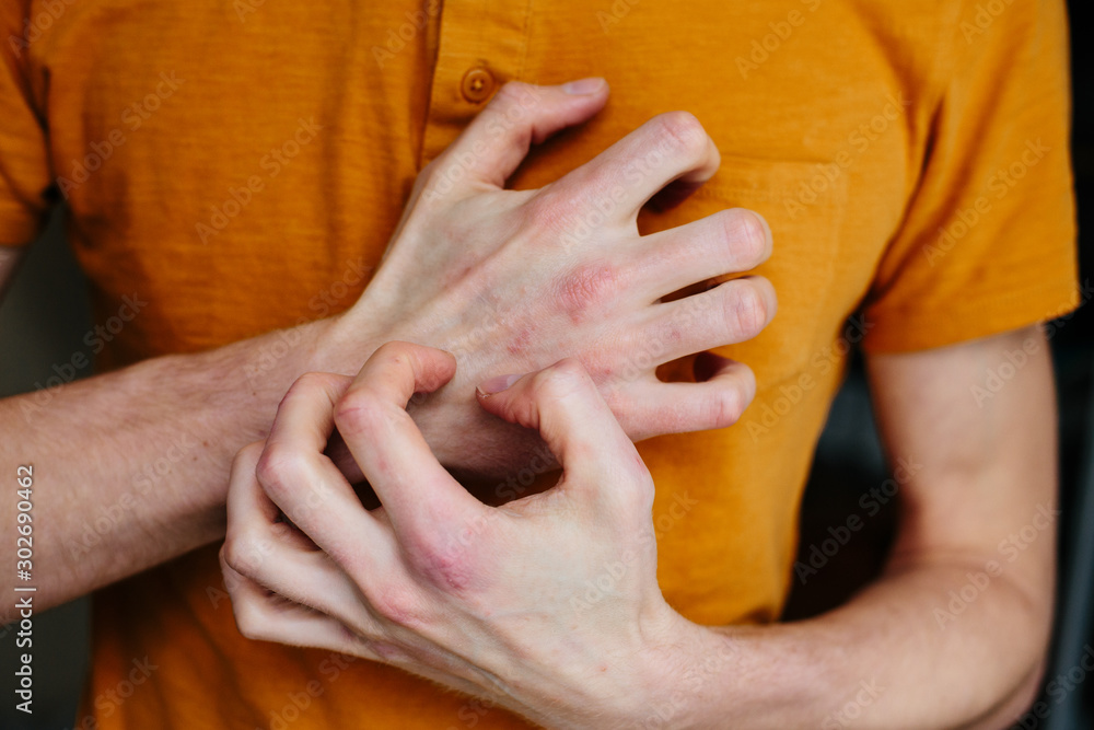 Man scratch oneself, dry flaky skin on hand with psoriasis vulgaris ...