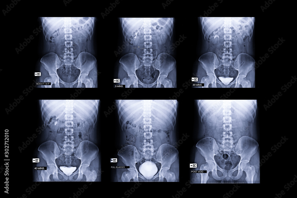 procedure of Intravenous pyelogram or IVP is an X-ray exam of urinary ...