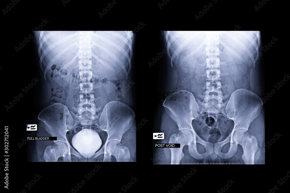 What Is An Intravenous Pyelogram Ivp