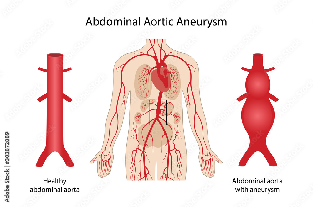 Plakat Abdominal aortic aneurysm. Arterial circulatory system of the ...
