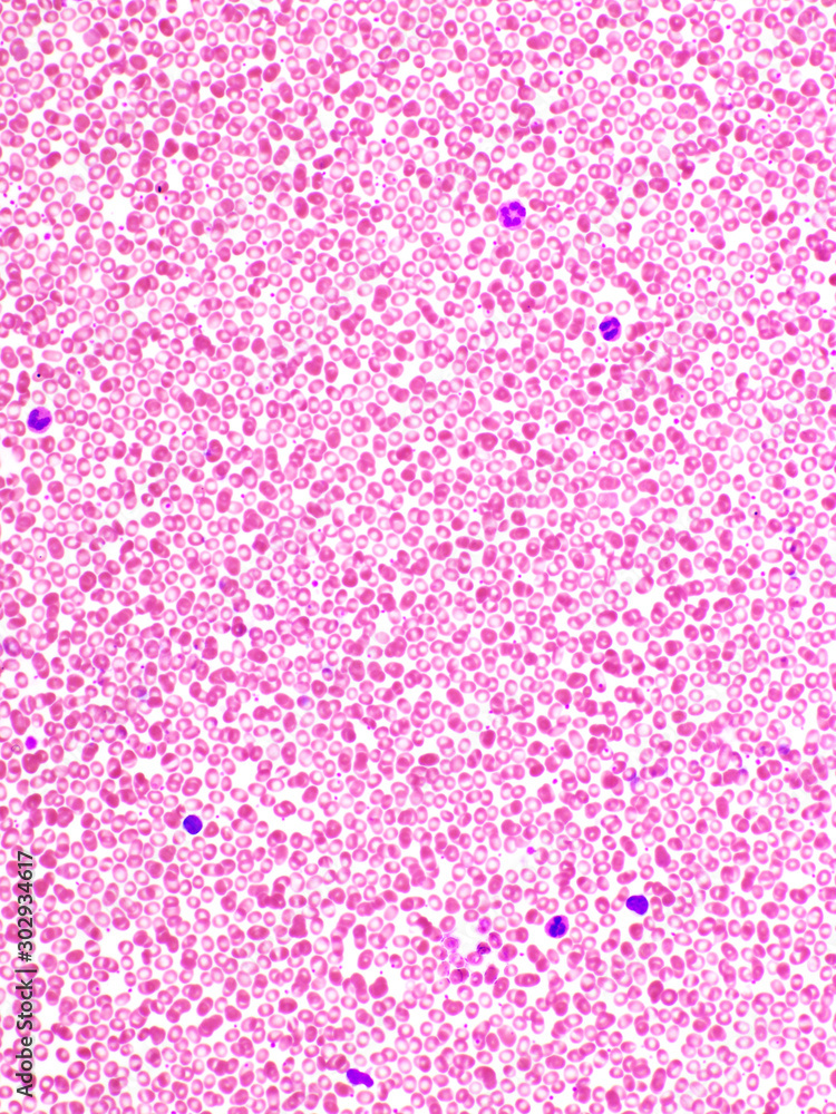 Picture of white blood cell, red blood cell and platelet in blood film ...
