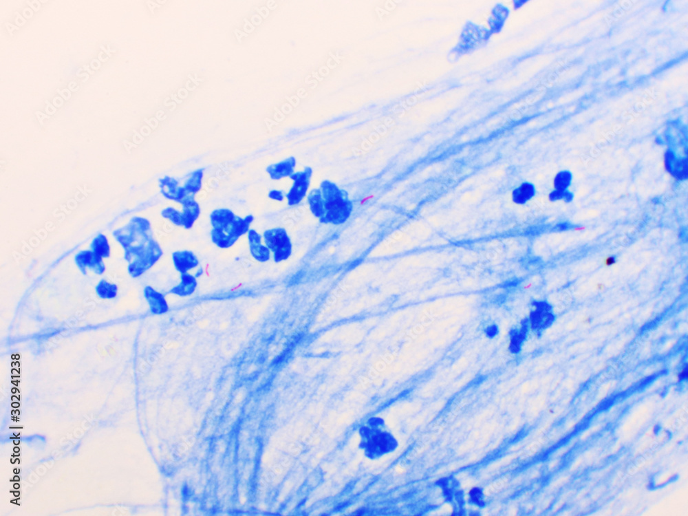 Mycobacterium tuberculosis positive (small red rod) in sputum smear ...