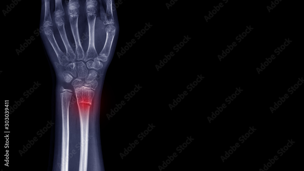 Foto de Film X-ray wrist radiograph show wrist bone broken (torus or ...