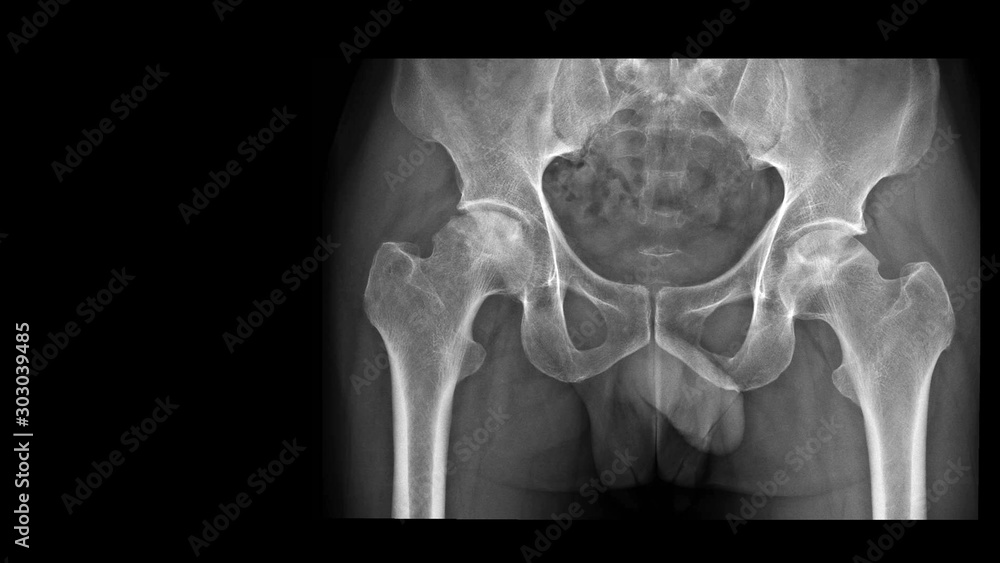Film X ray hip radiograph show bilateral femoral head collapse form ...