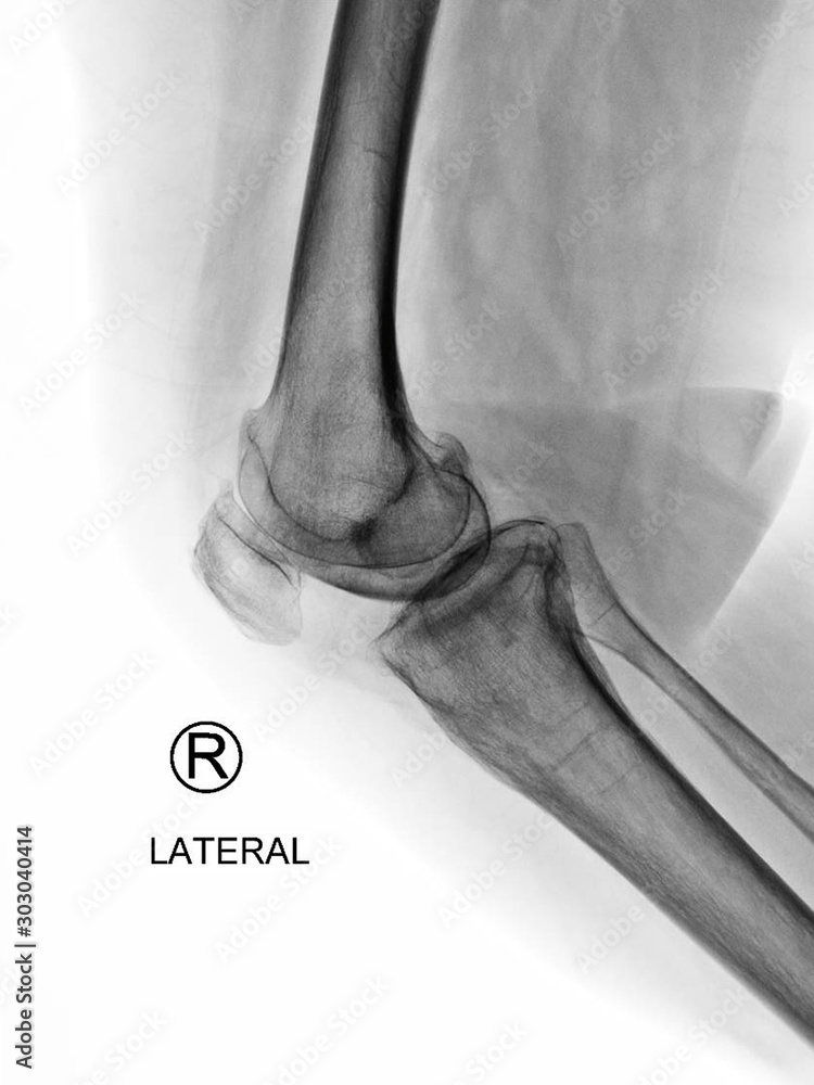 Film X-ray knee radiograph show inflammatory arthritis disease (IA ...