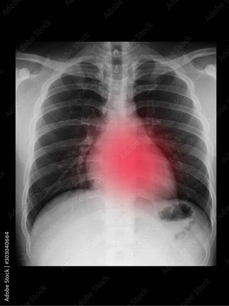 Film x-ray chest radiograph (CXR) show normal human anatomy of heart ...