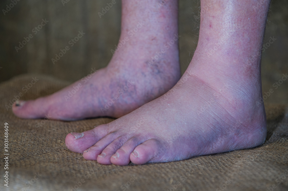 An elderly man with bare legs draws an iodine grid at the site of a ...