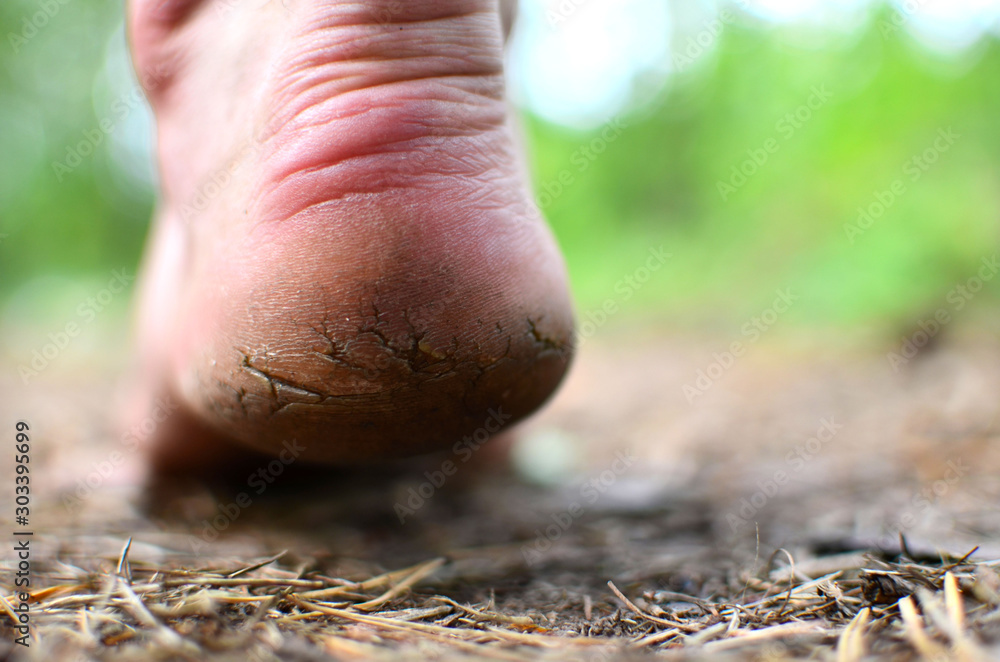 Men's foot with rough skin and a dry heel with many cracks. The concept ...