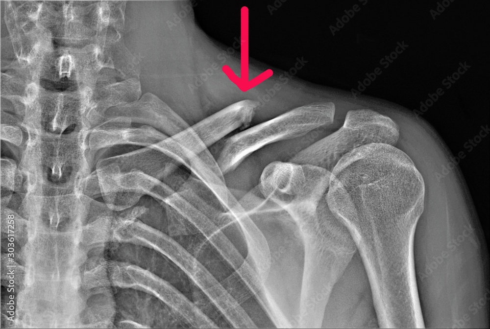 radiography of the shoulder joint and ribs in direct projection with a ...
