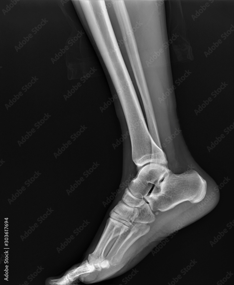 normal radiography of the ankle joint in lateral projection ...