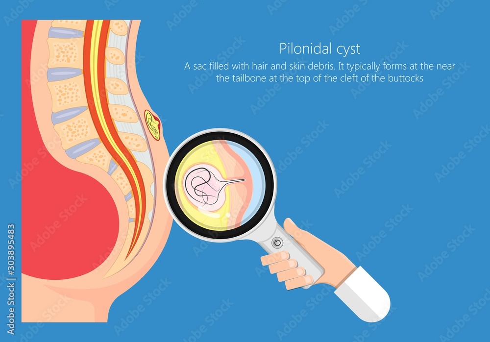 Pilonidal cyst nest of hair causes from excessive prolonged sitting ...