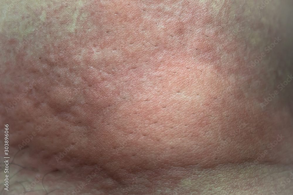 urticaria on skin. rashes, of which urticaria and toxic erythema are ...