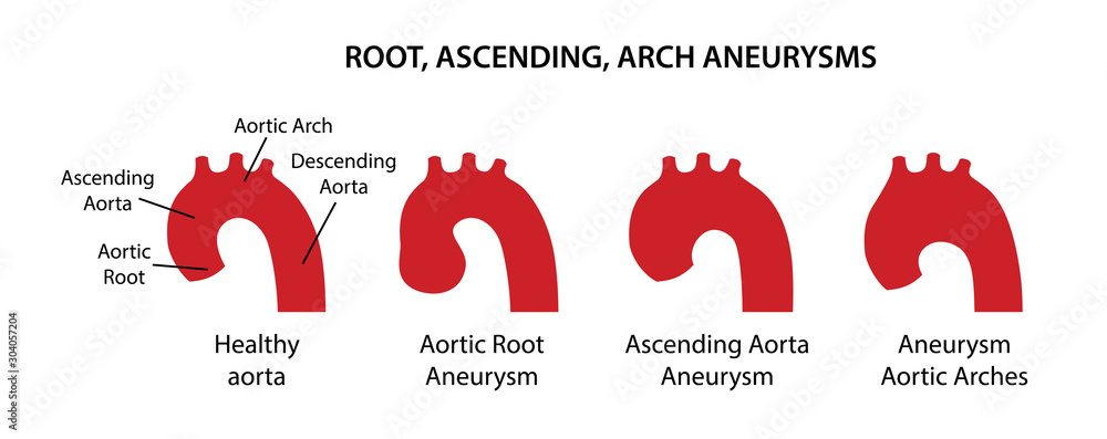 Plakat w ramie Types of aortic aneurysms: root, ascending, arch ...