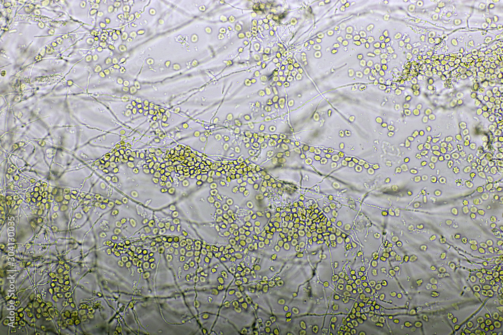 Picture of fungus and red blood cells in hemoculture tube, analyze by ...