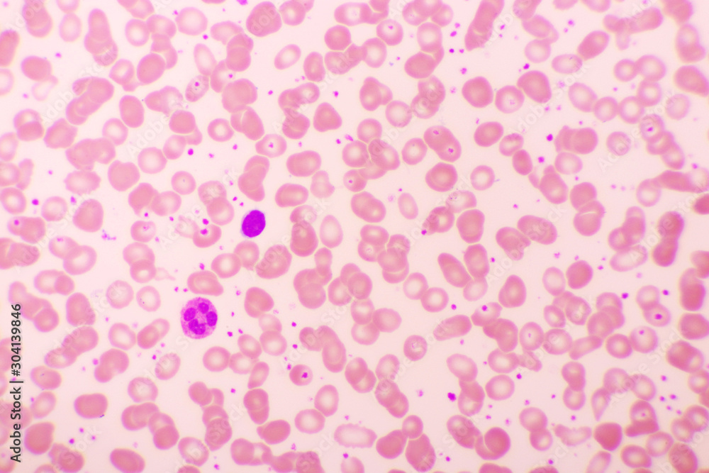 Essential thrombocytosis blood smear, present abnormal high platelet ...
