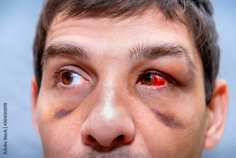 face of a white person with bruises under the eyes and an eye damaged ...