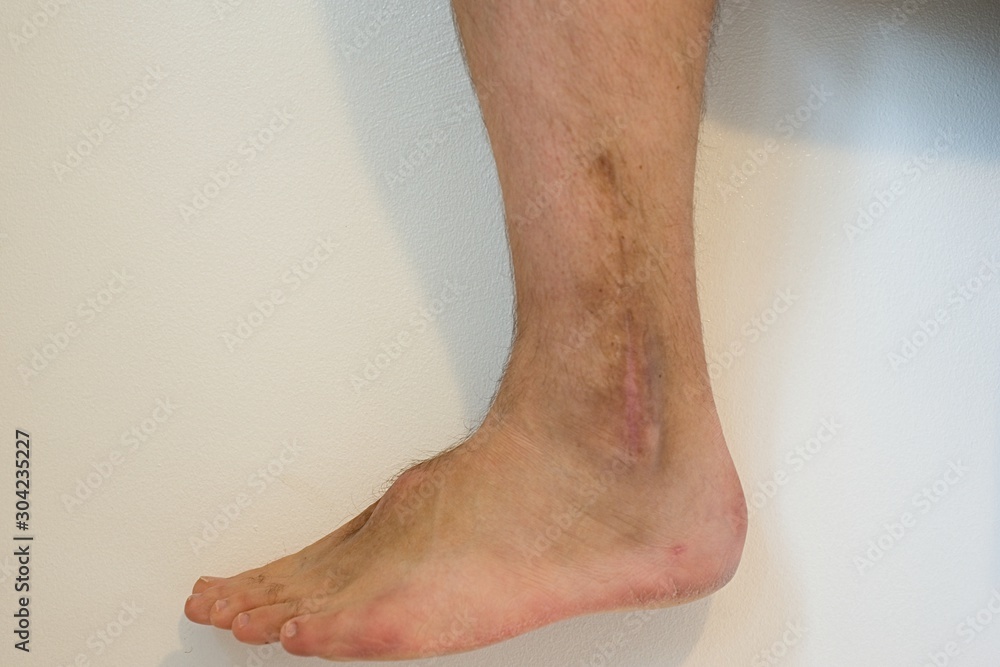 Left foot following high energy impact and rotation, Lisfranc joint ...
