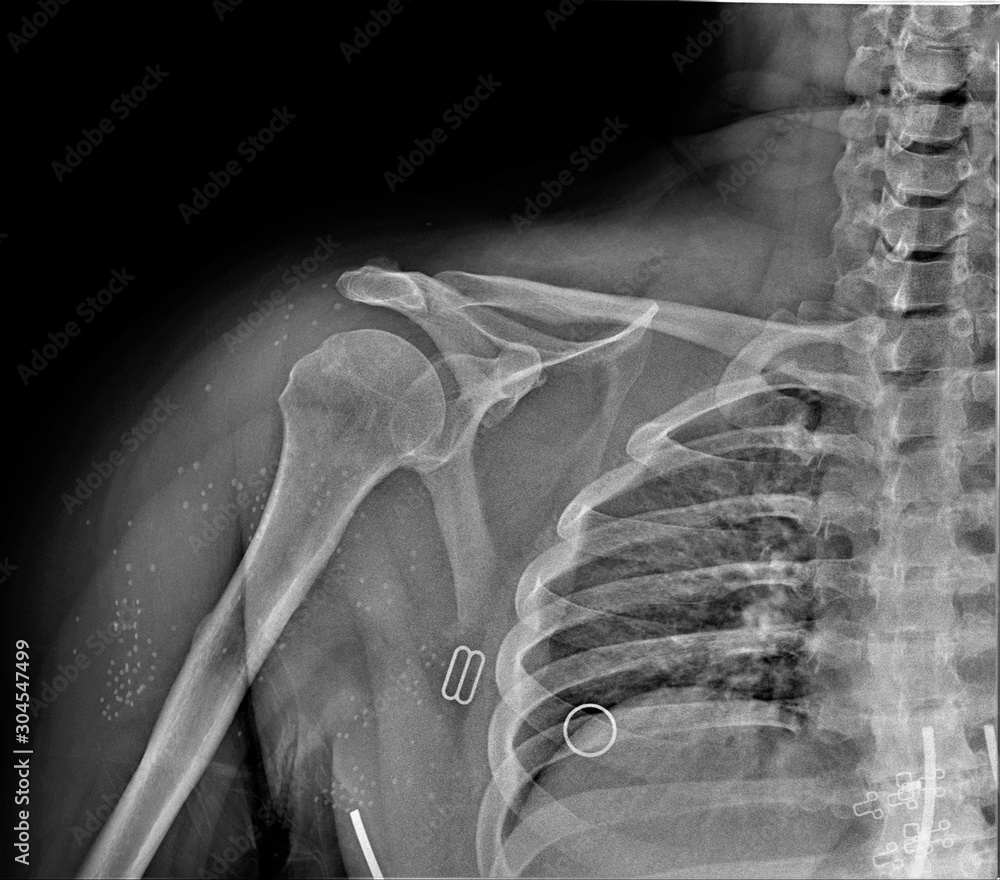 Foto de normal radiography of the shoulder joint in direct projection ...