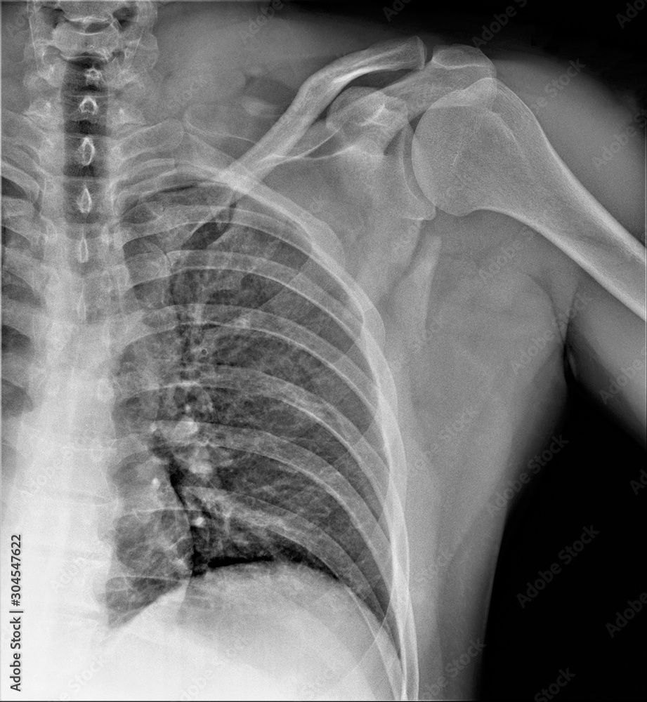 normal radiography of the shoulder joint in direct projection ...