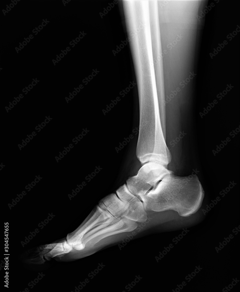 normal radiography of the ankle joint in lateral projection ...