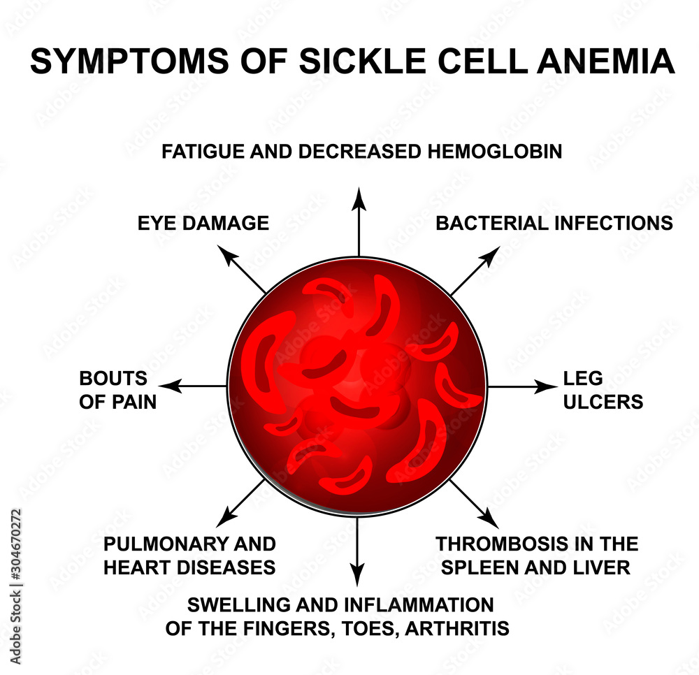 Symptoms of sickle cell anemia. World Sickle Cell Anemia Day 19 June ...