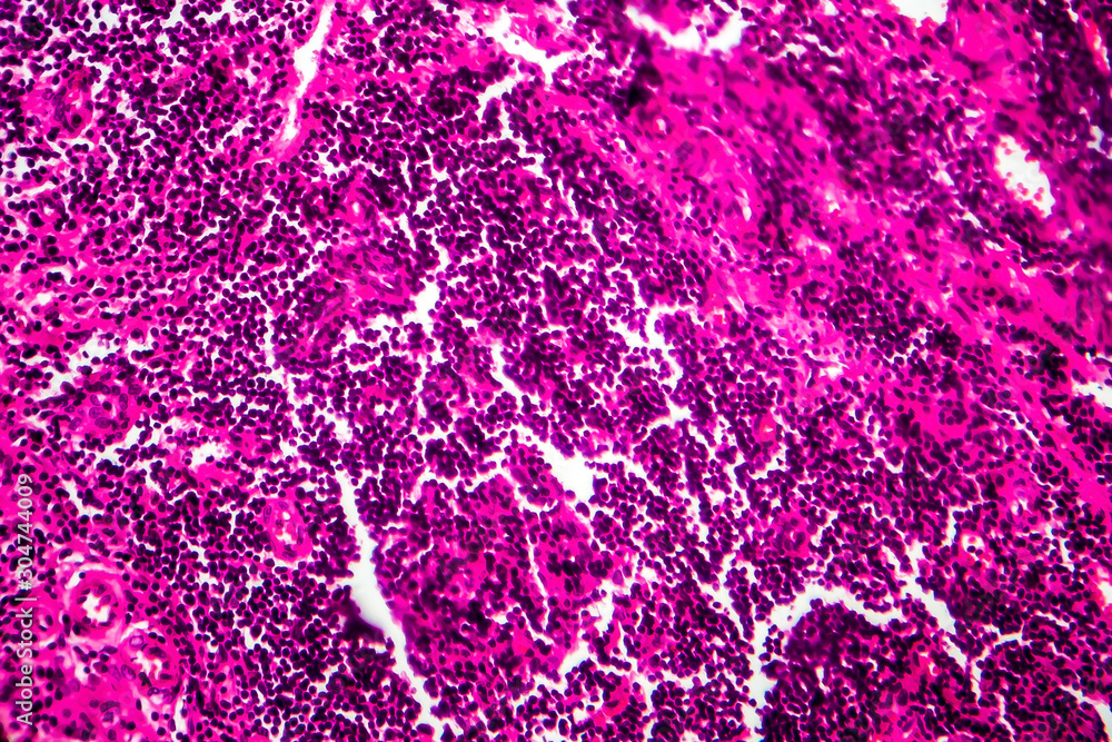 Bladder cancer, light micrograph, photo under microscope Stock Photo ...