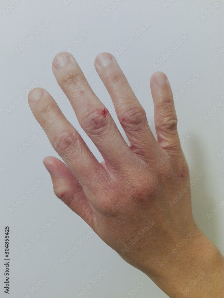 The back of female hand gets dried, cracked, reddened, itchy, flaking ...