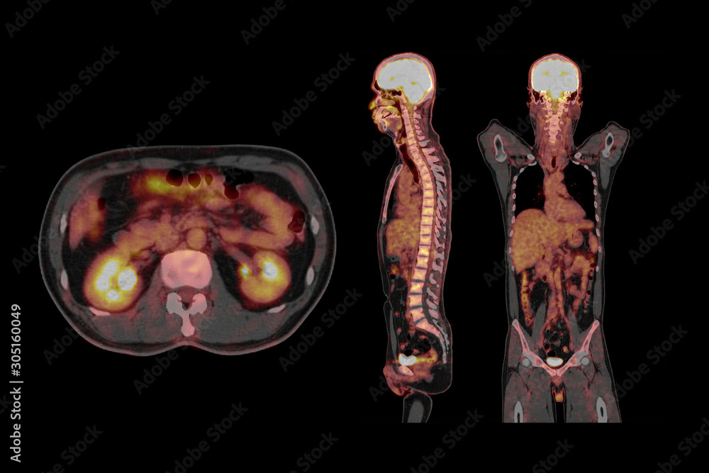 PET CT Scan fusion image Stock Photo | Adobe Stock